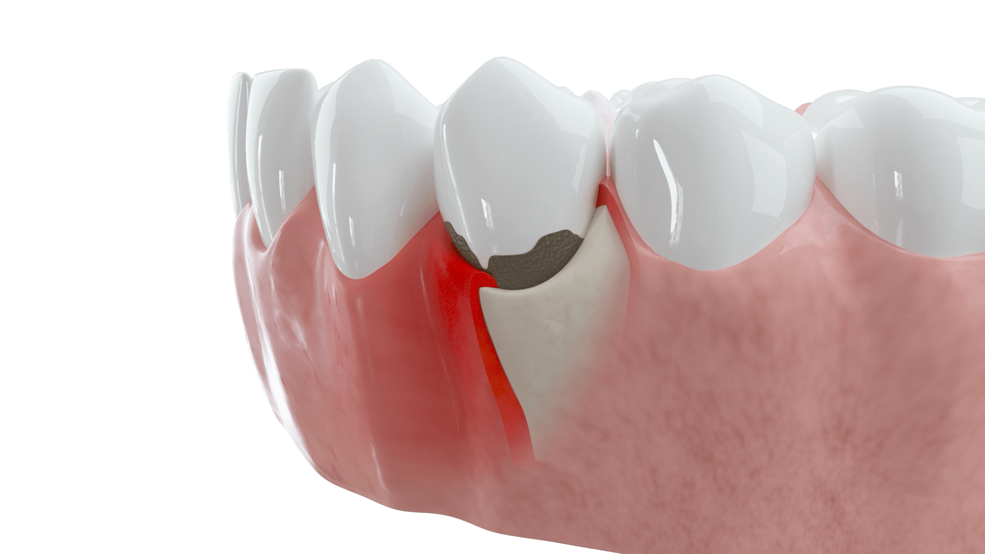 Parodontitis — van Bladel & Tinnefeld